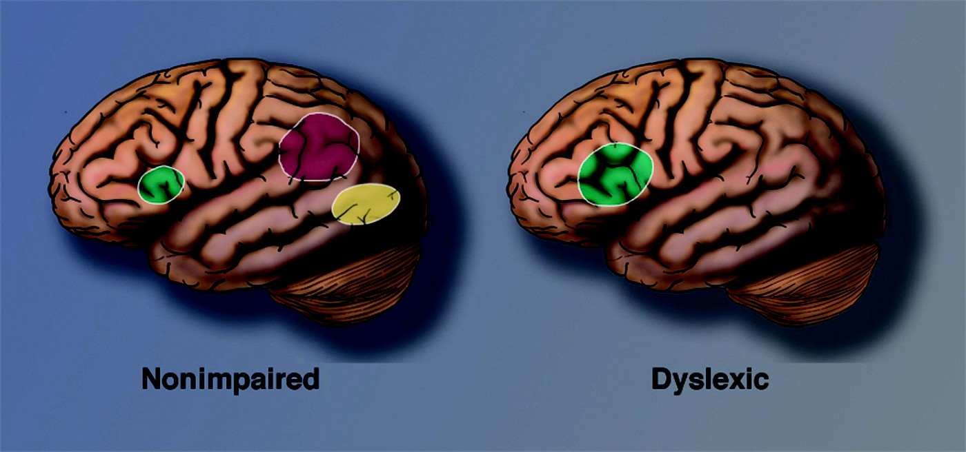 Paying attention to reading: The neurobiology of reading and dyslexia ...