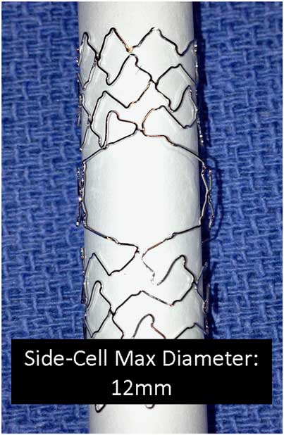 The Valeo stent: a pre-mounted, open-cell, large stent for use in small ...