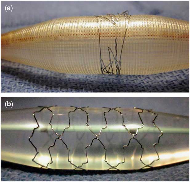 The Valeo stent: a pre-mounted, open-cell, large stent for use in small ...