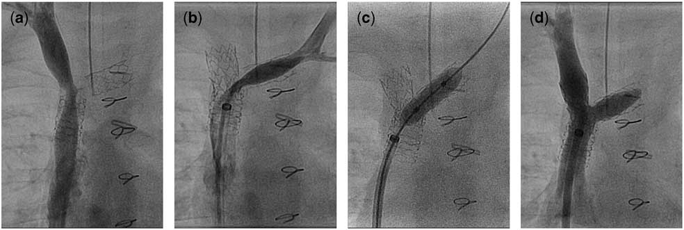 The Valeo stent: a pre-mounted, open-cell, large stent for use in small ...