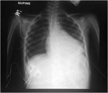 Lessons learned with the use of CentriMag as short-term ventricular ...