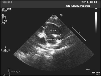Truncus arteriosus communis in combination with cor triatriatum ...