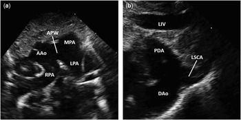Berry syndrome: the importance of genetic evaluation before surgical ...