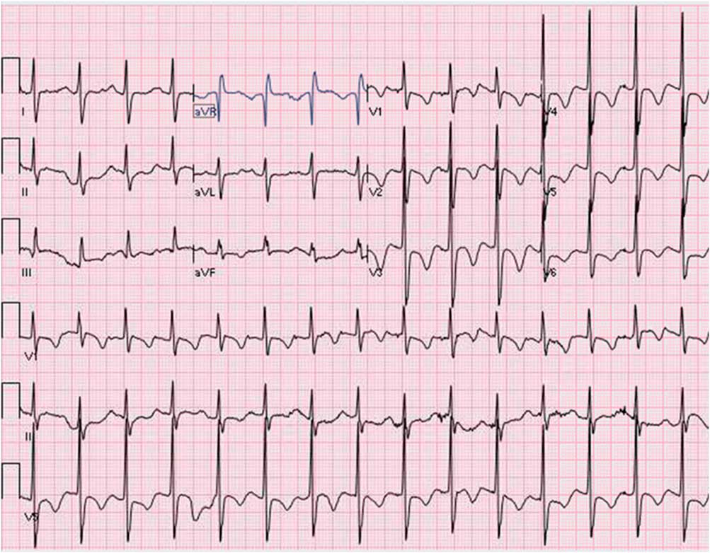 Electrocardiac effects associated with lithium toxicity in children: an ...