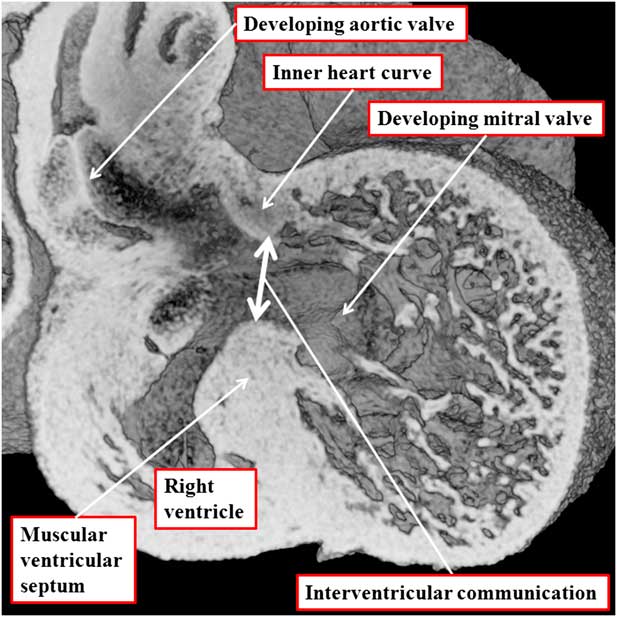 What is aortic overriding? | Cardiology in the Young | Cambridge Core