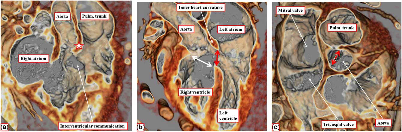 What is aortic overriding? | Cardiology in the Young | Cambridge Core