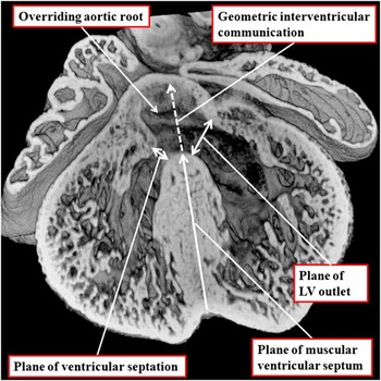 What is aortic overriding? | Cardiology in the Young | Cambridge Core