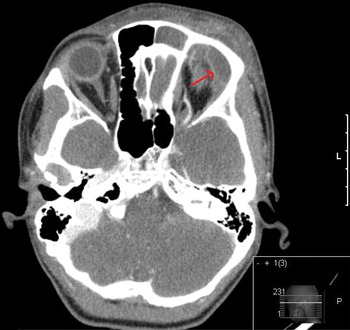 Complicated periorbital cellulitis: case report and literature review ...