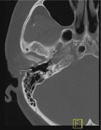 Temporomandibular joint fistula into the external ear canal | The ...