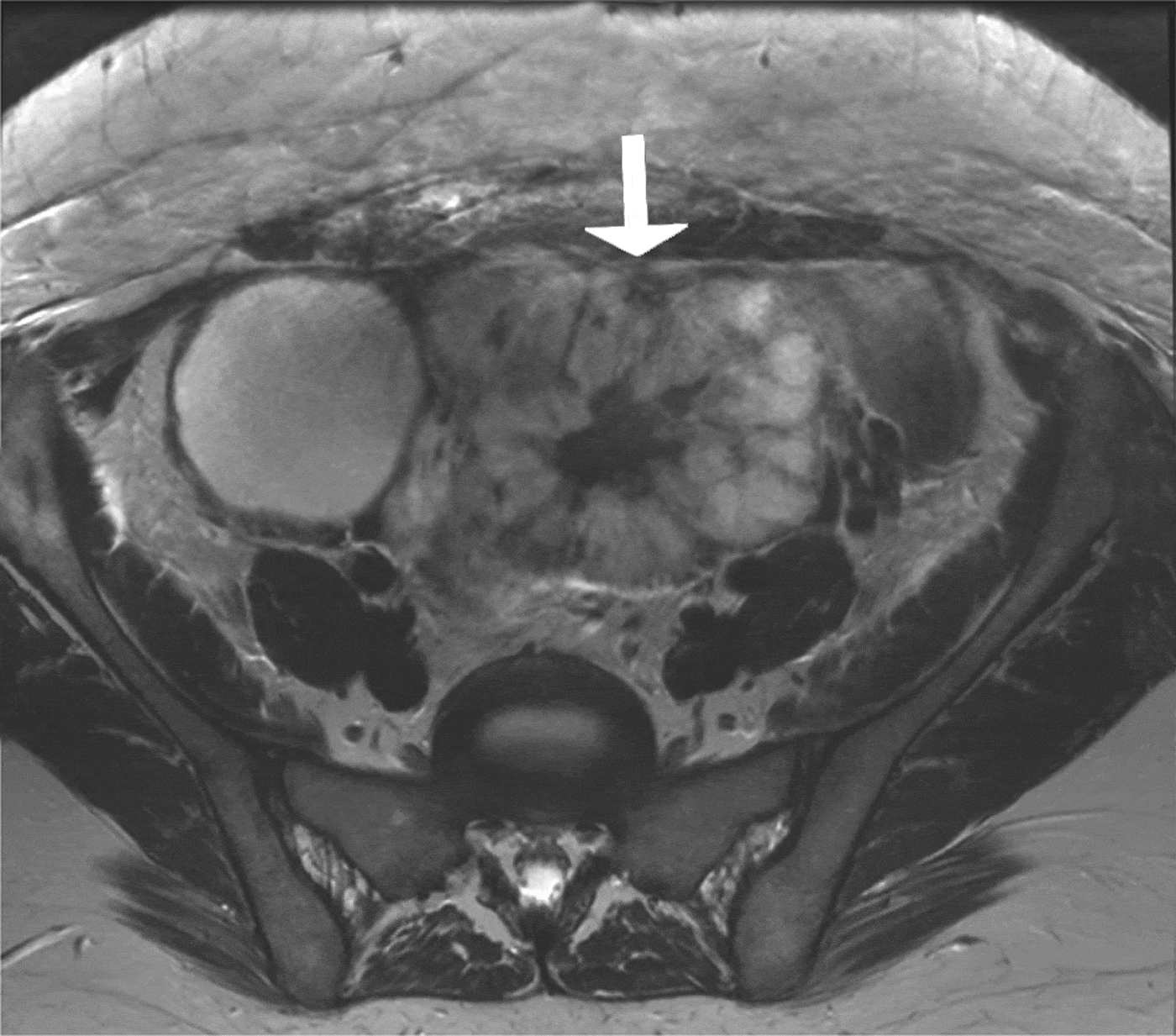 Struma ovarii and the thyroid surgeon | The Journal of Laryngology ...