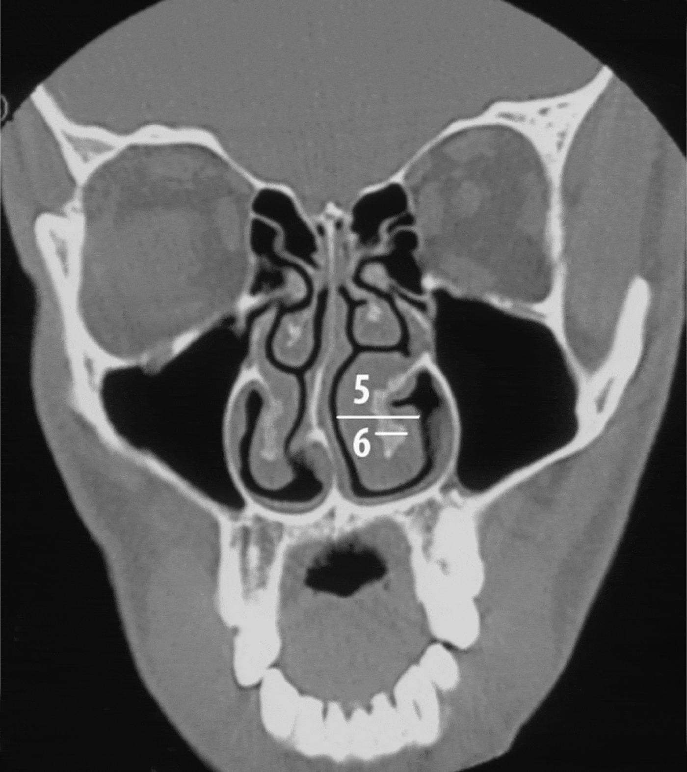 Evaluation of inferior turbinate hypertrophy in patients with ...
