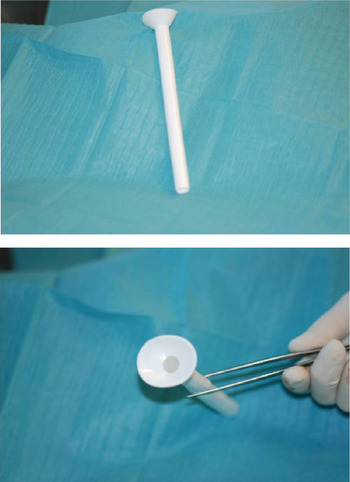 Role of Montgomery salivary stent placement during pharyngolaryngectomy ...