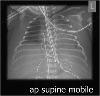 Successful emergency cardiac pacing and permanent pacemaker insertion ...