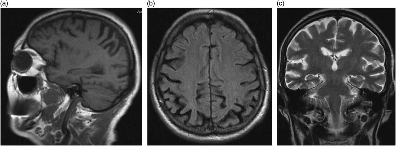 Upside-down Drawing in Posterior Cortical Atrophy | Canadian Journal of ...