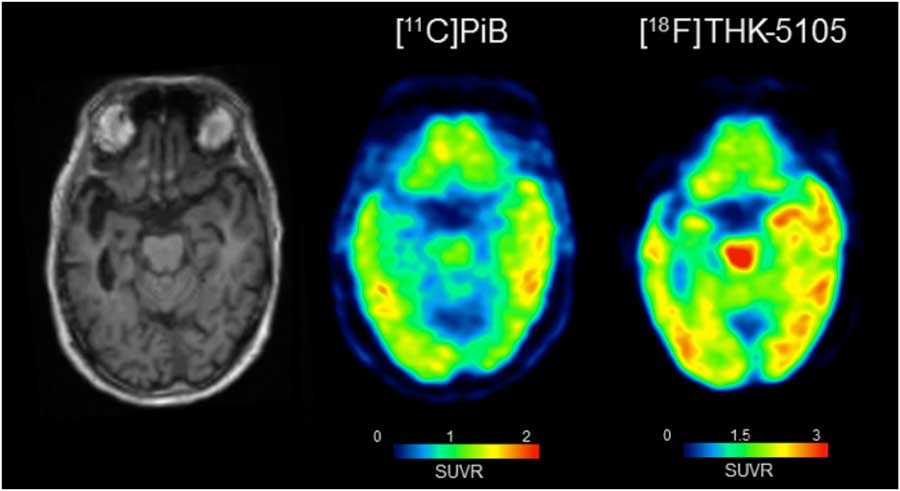 Developments in Tau PET Imaging | Canadian Journal of Neurological ...