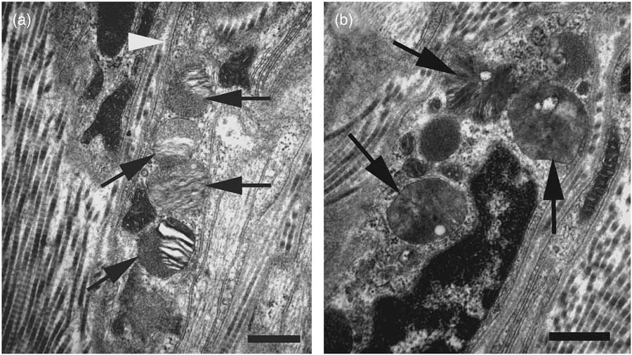 Case of Multiple Sulfatase Deficiency and Ocular Albinism: A Diagnostic ...