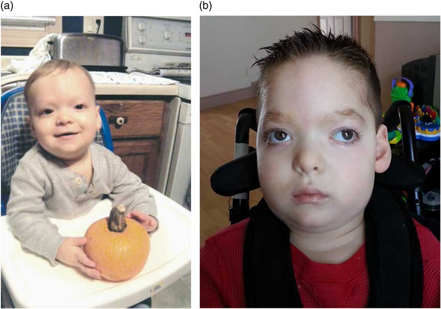 Case of Multiple Sulfatase Deficiency and Ocular Albinism: A Diagnostic ...
