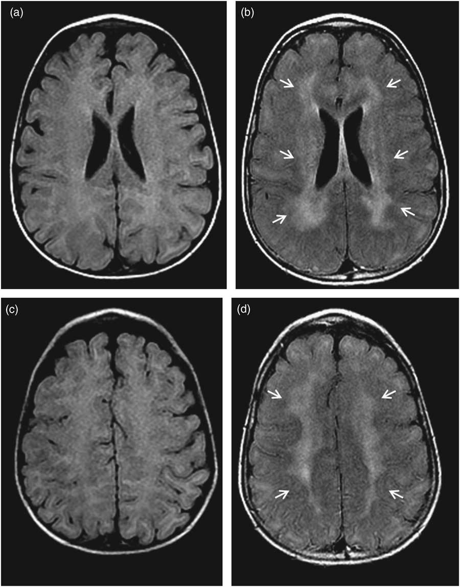 Case of Multiple Sulfatase Deficiency and Ocular Albinism: A Diagnostic ...