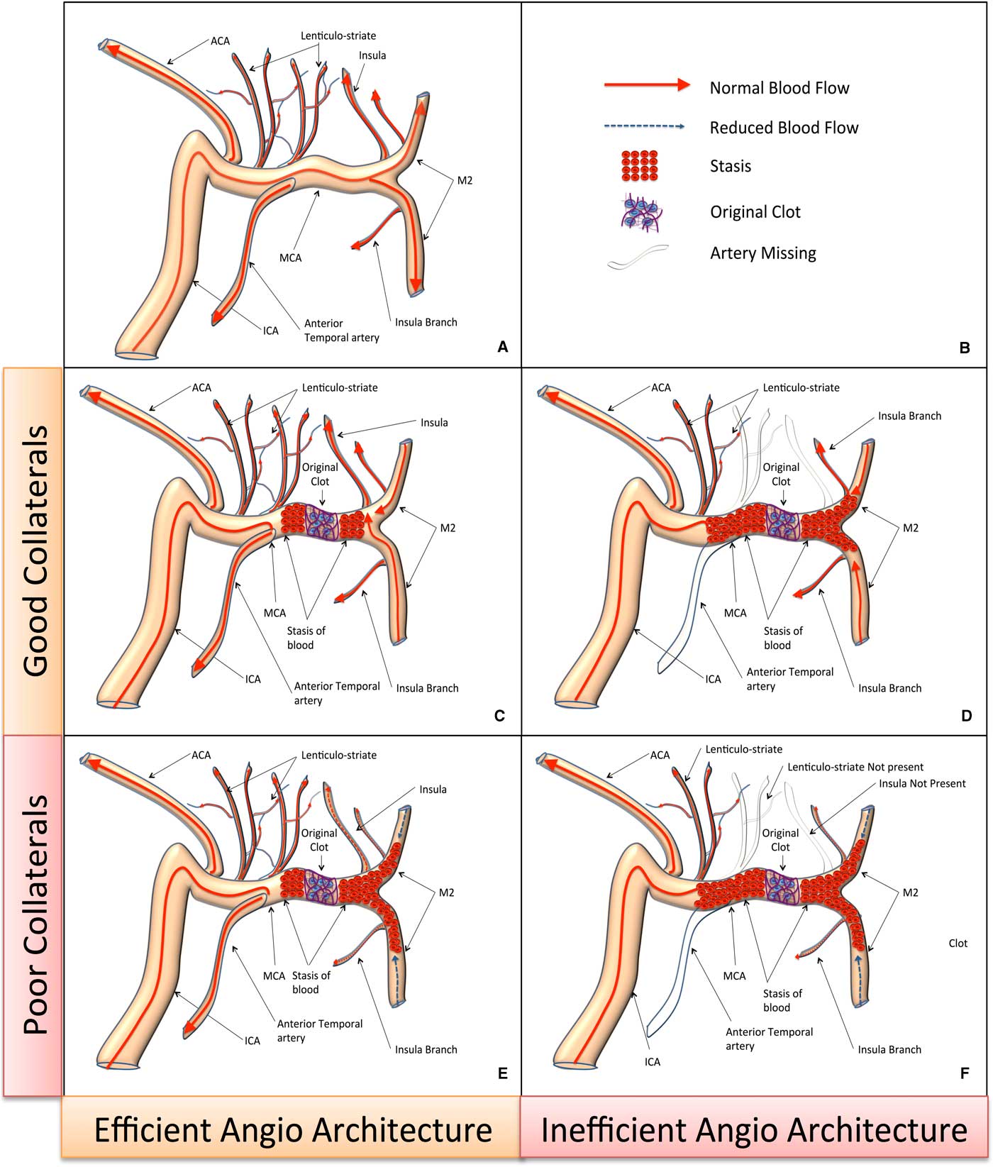 Thrombus Characteristics Are Related to Collaterals and ...
