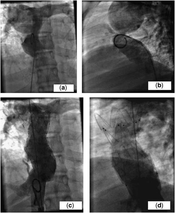 Use of a self-expanding custom-made stent graft to treat lateral tunnel ...