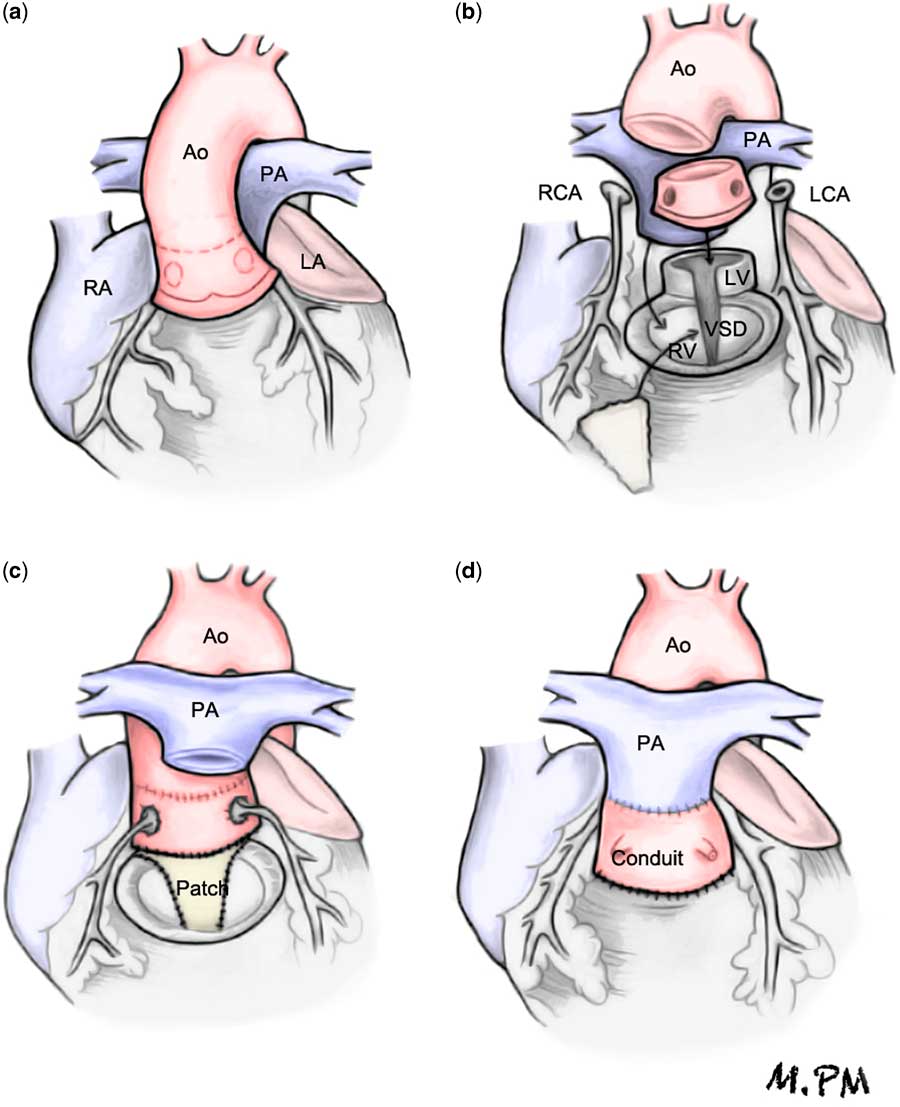 The Nikaidoh procedure for complex transposition of the great arteries ...