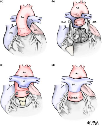 The Nikaidoh procedure for complex transposition of the great arteries ...