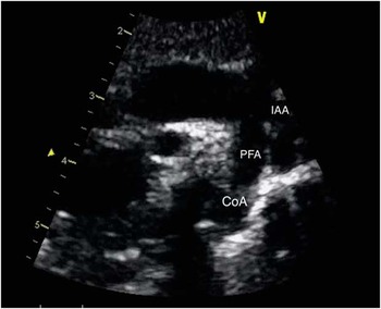 Aortic arch advancement for type A interrupted aortic arch with ...
