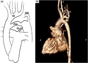 Aortic arch advancement for type A interrupted aortic arch with ...