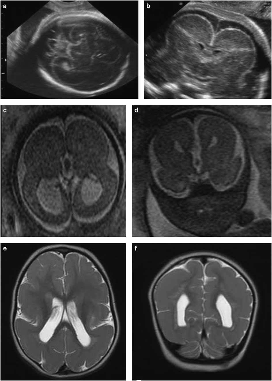 Malformations of Cortical Development: From Postnatal to Fetal Imaging ...