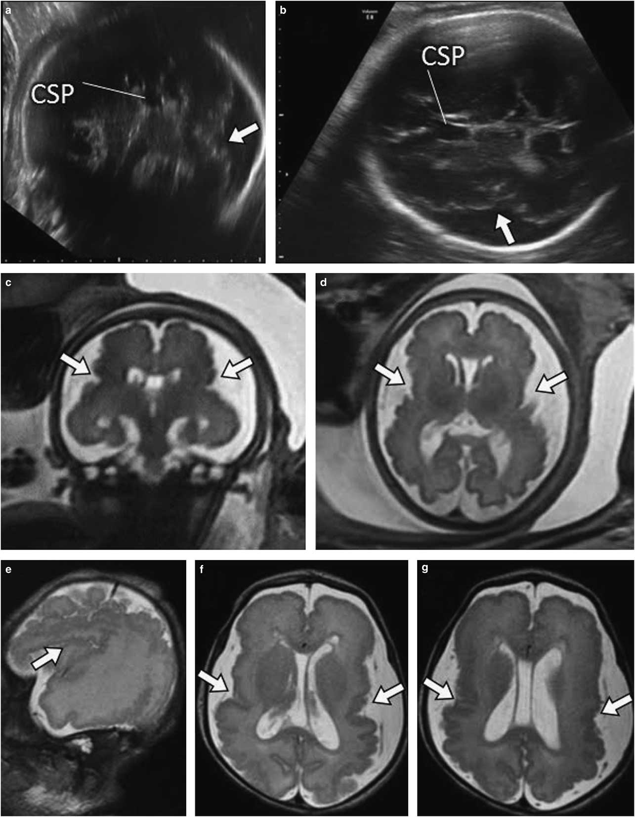 Malformations of Cortical Development: From Postnatal to Fetal Imaging ...