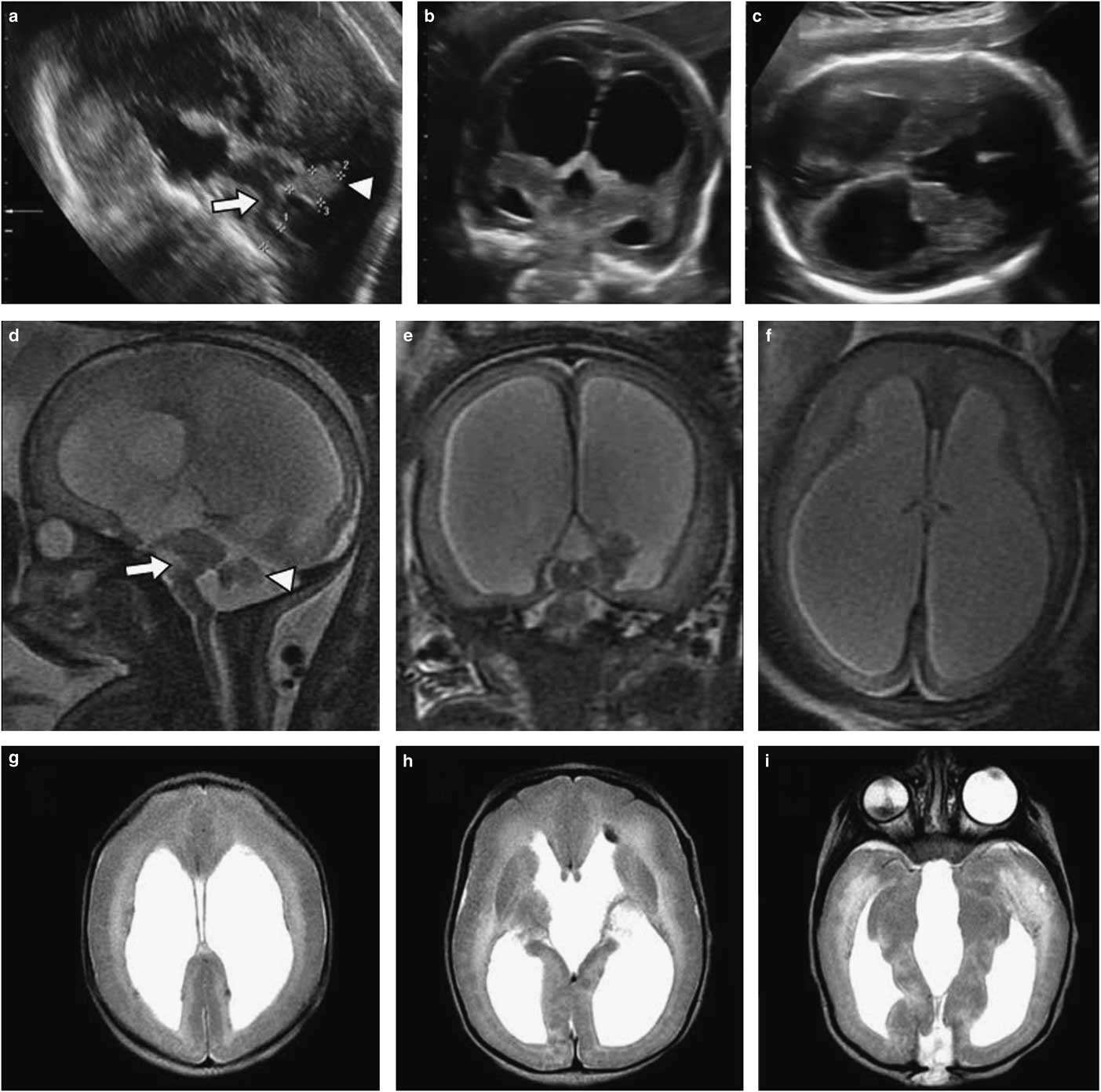 Malformations of Cortical Development: From Postnatal to Fetal Imaging ...