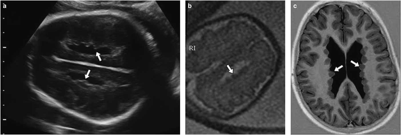 Malformations of Cortical Development: From Postnatal to Fetal Imaging ...