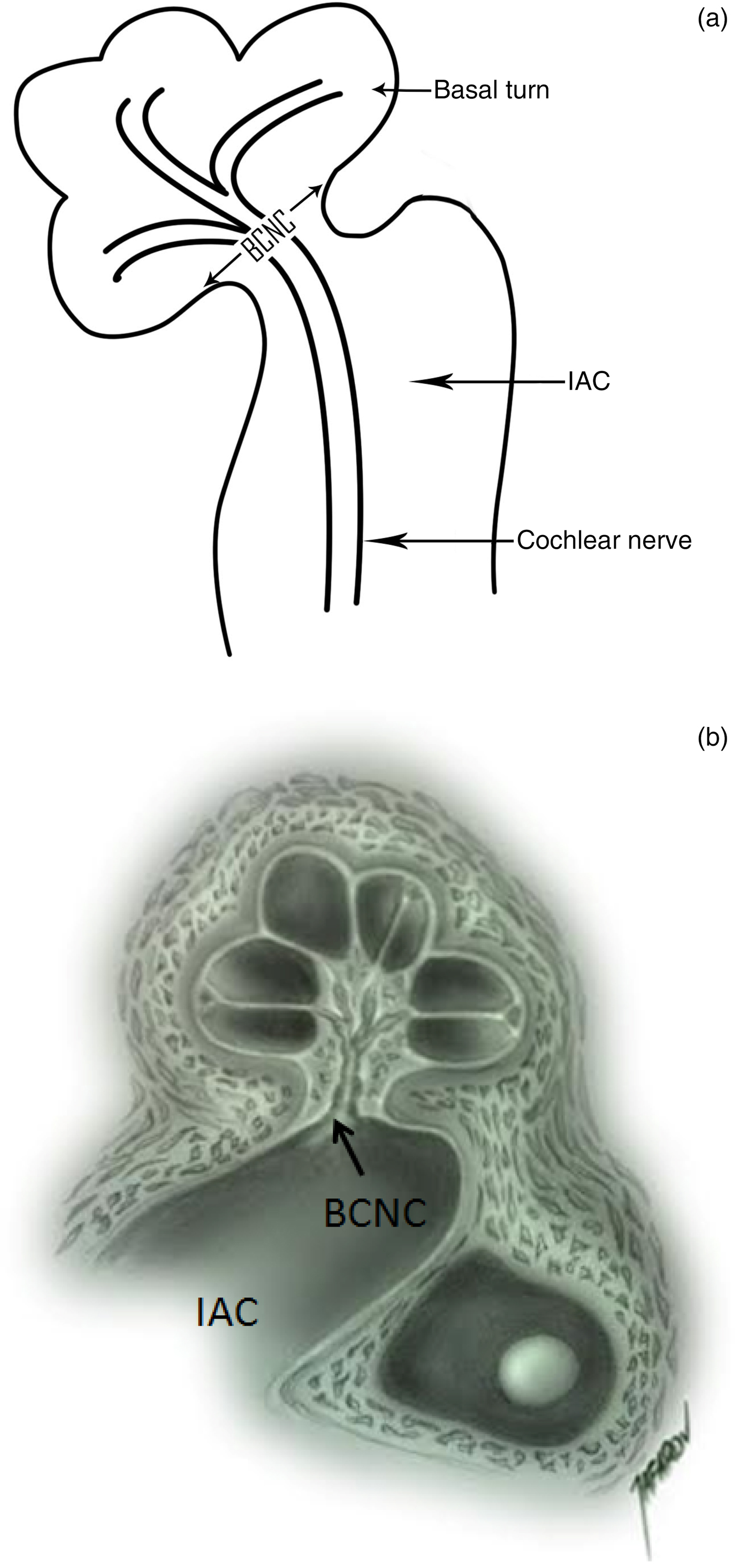 Bony cochlear nerve canal and internal auditory canal measures predict ...
