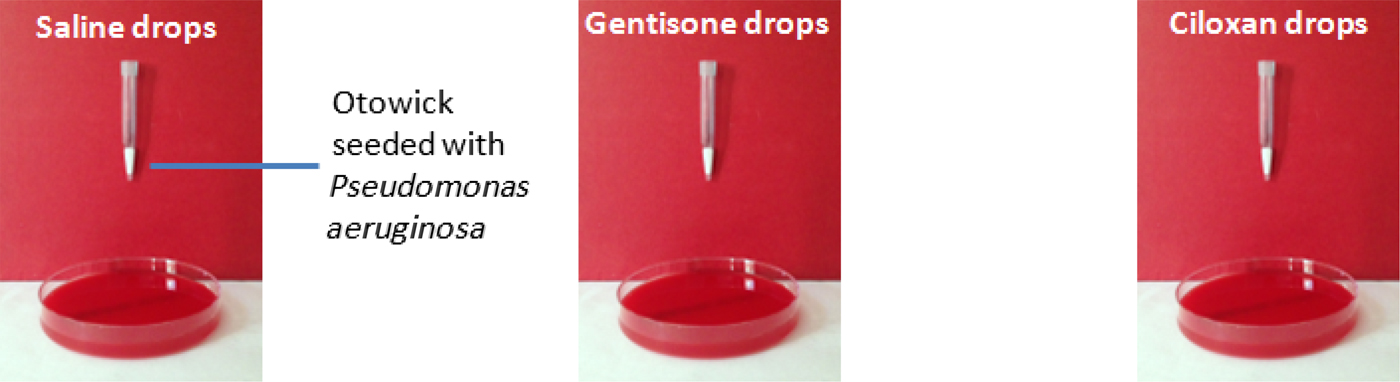Optimising the use of otowicks in otitis externa | The Journal of ...