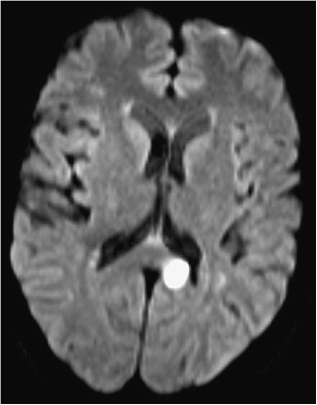 View-Dependent Prosopometamorphopsia after Stroke | Canadian Journal of ...