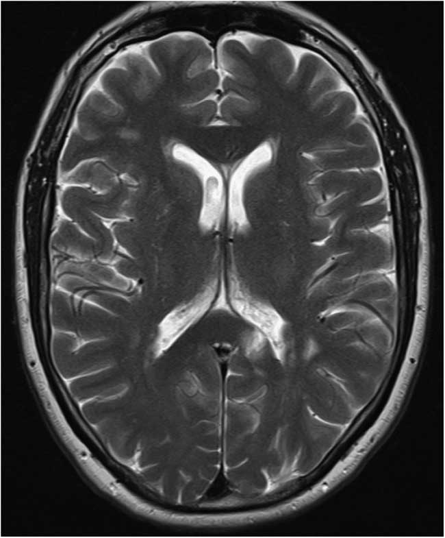 View-Dependent Prosopometamorphopsia after Stroke | Canadian Journal of ...