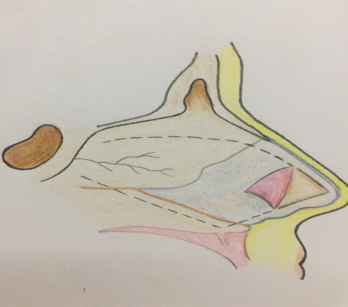 Feasibility of a septal mucosal flap for preventing re-stenosis ...