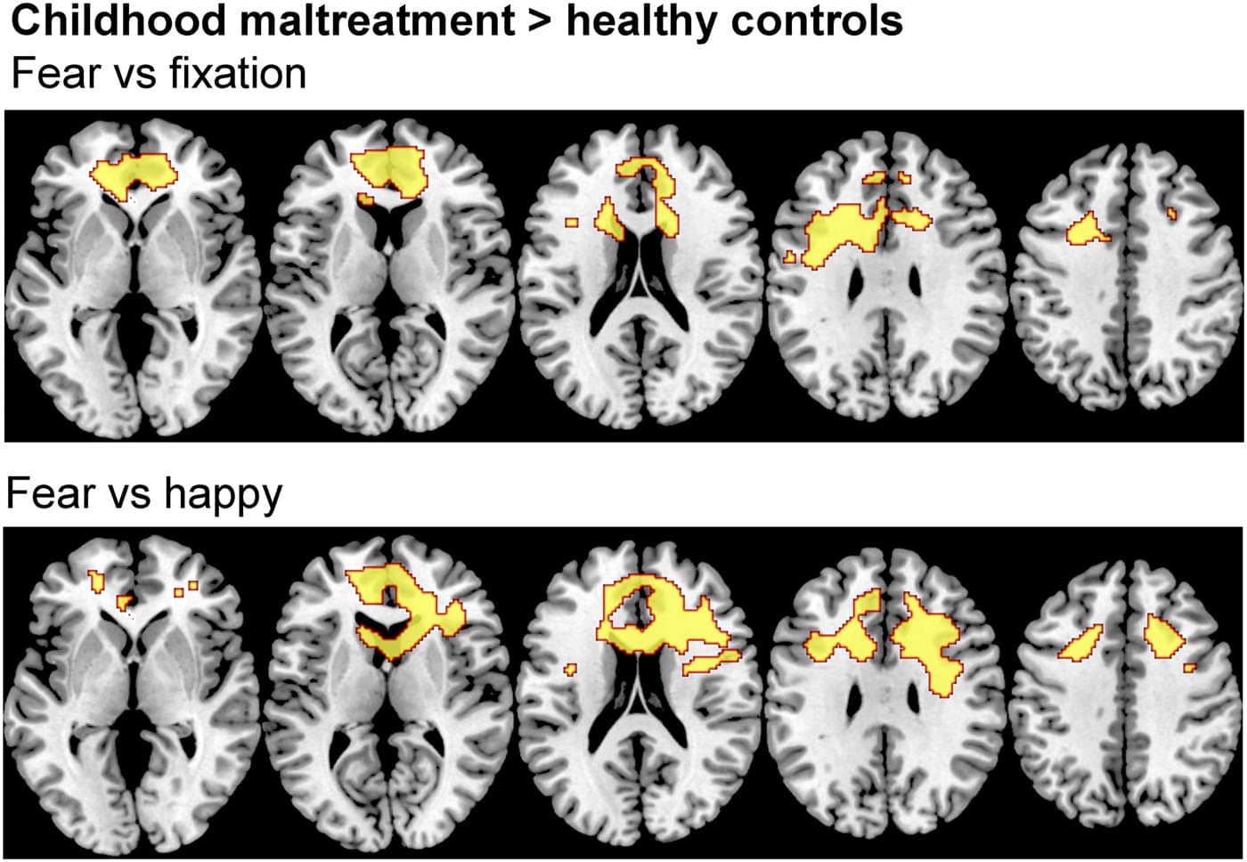 Altered fear processing in adolescents with a history of severe ...