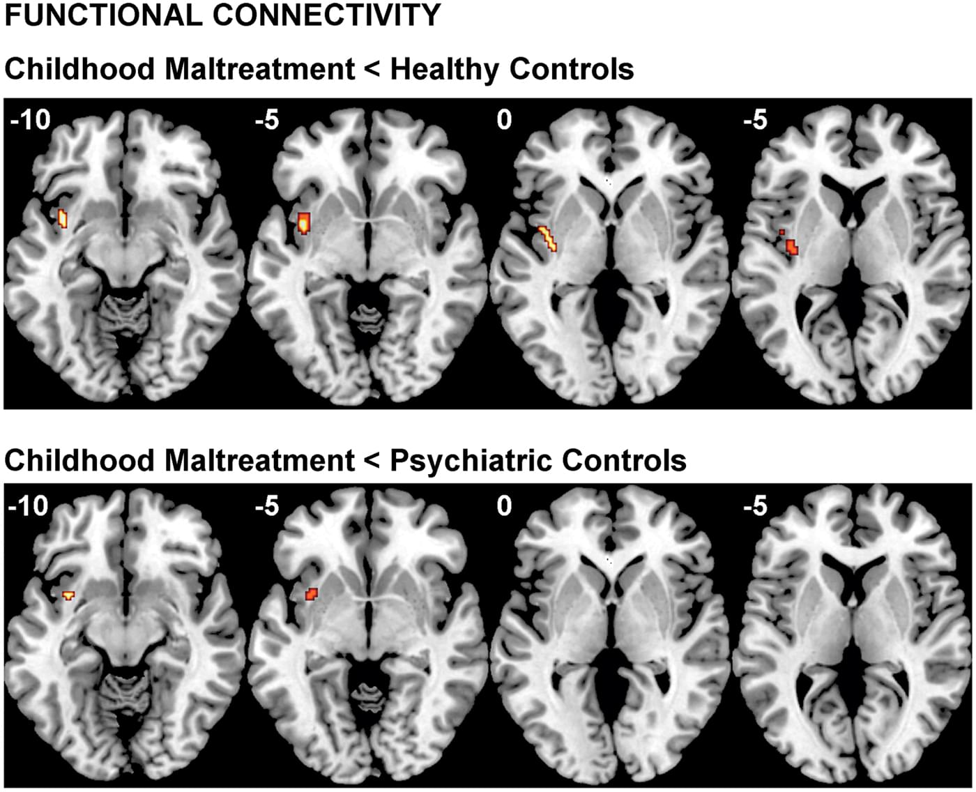 Altered fear processing in adolescents with a history of severe ...