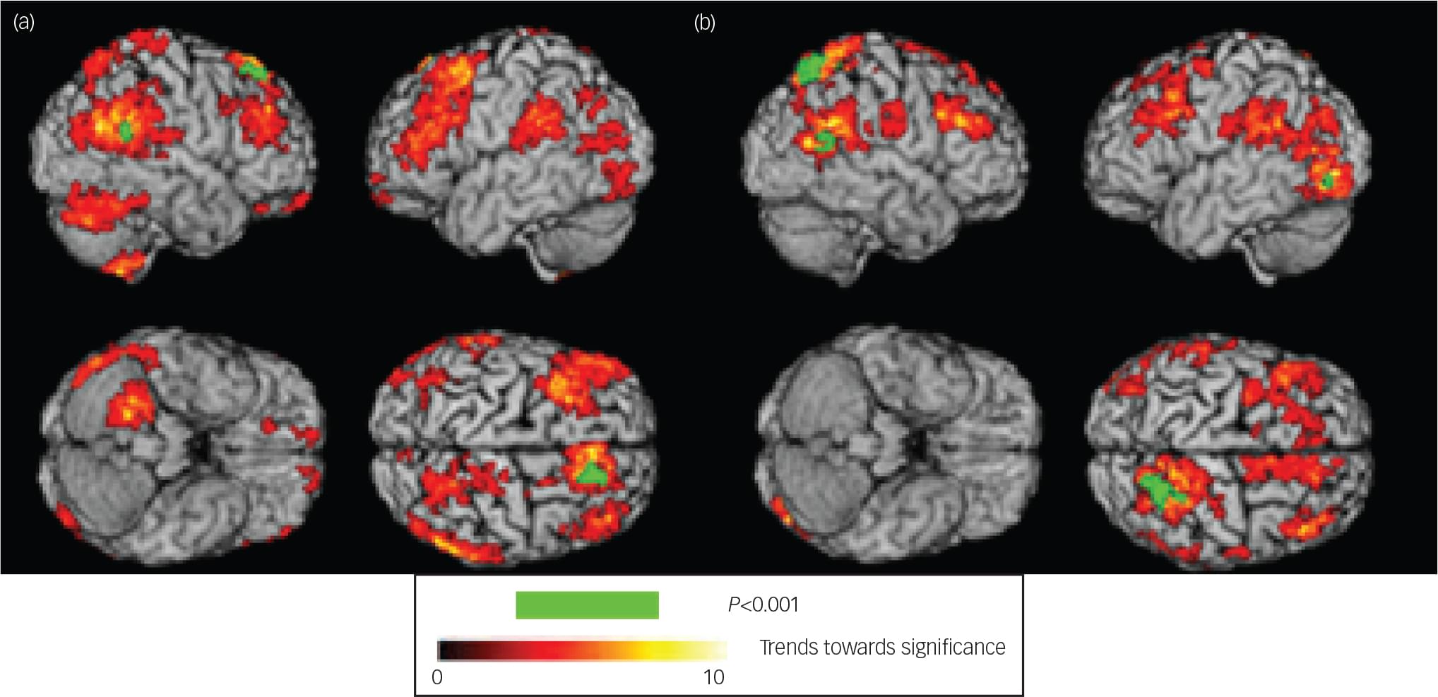 Diagnostic potential of structural neuroimaging for depression from a ...