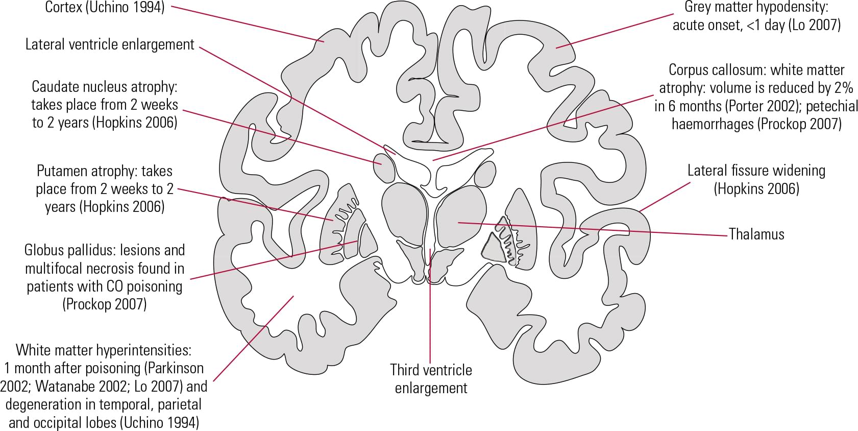Neuropsychiatric aspects of carbon monoxide poisoning: diagnosis and ...