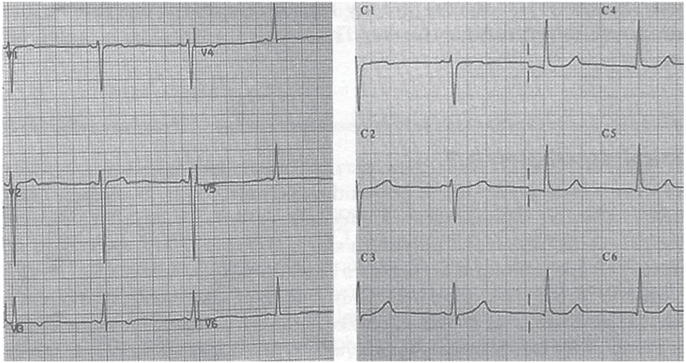 MARSIPAN: management of really sick patients with anorexia nervosa ...