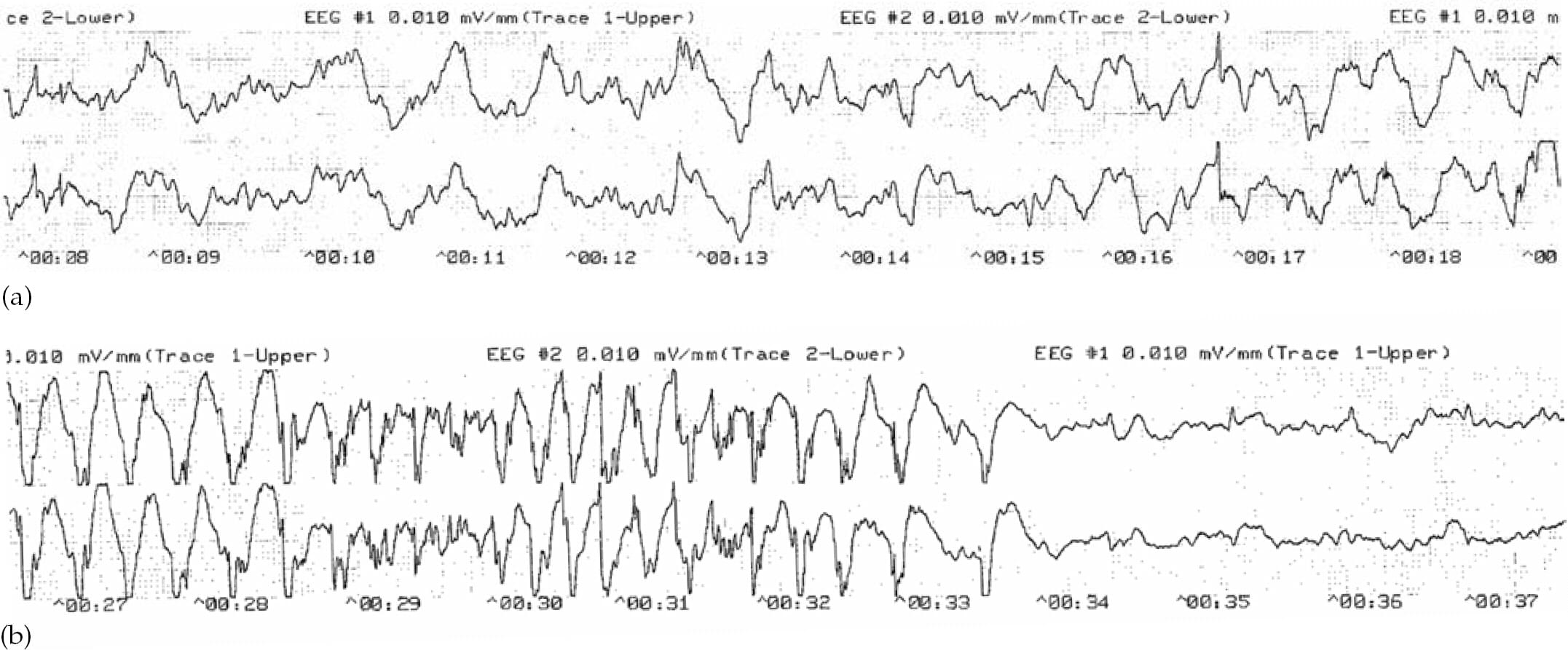 Monitoring electroconvulsive therapy by electroencephalogram: an update ...
