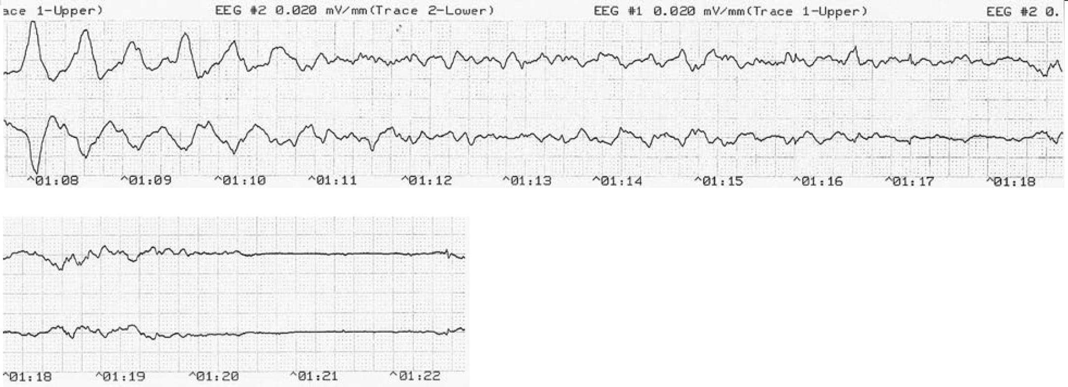 Monitoring electroconvulsive therapy by electroencephalogram: an update ...