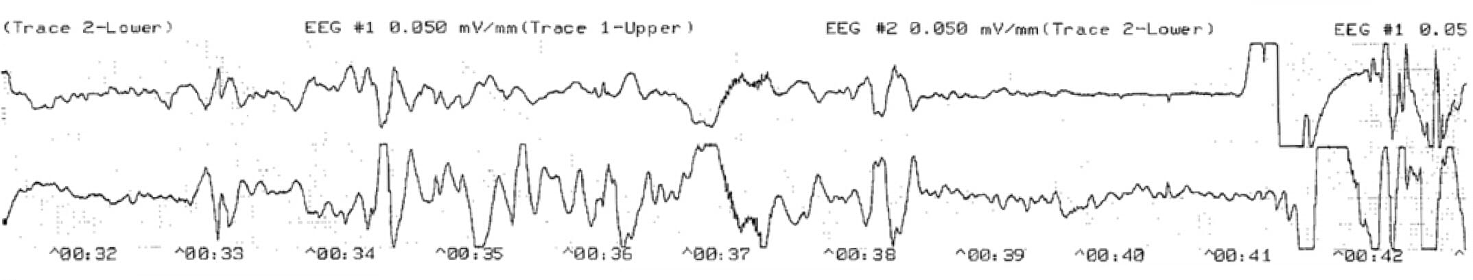 Monitoring electroconvulsive therapy by electroencephalogram: an update ...