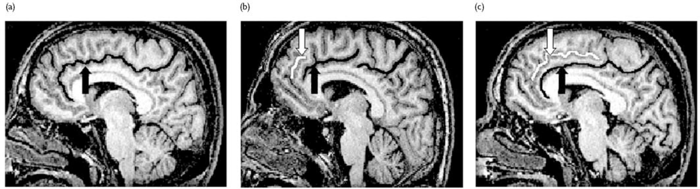 Paracingulate sulcus morphology in men with early-onset schizophrenia ...