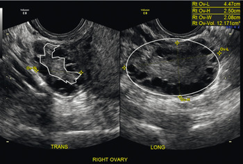 Ultrasound Polycystic Ovary Syndrome