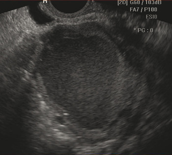 Monitoring Ovulation Ultrasound