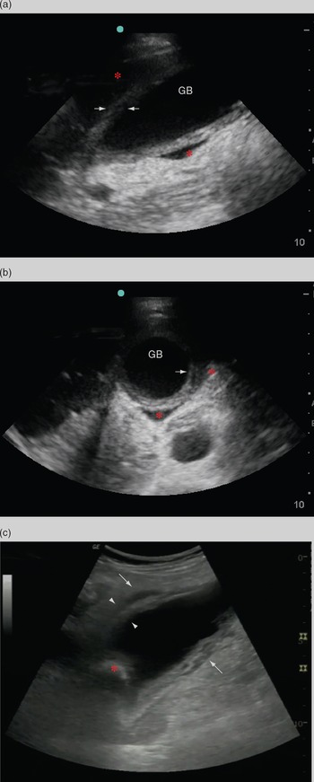 Gallbladder Anatomy Hartmann Pouch