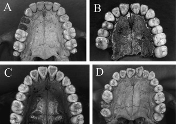 Indian Teeth Traits
